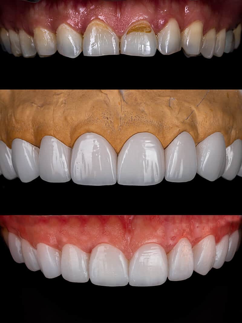 Diseño de sonrisa con carillas en resina. Premium Dental Medellín