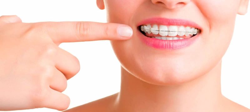 Elementos de un Kit de Ortodoncia y como usarlos | Premium Dental