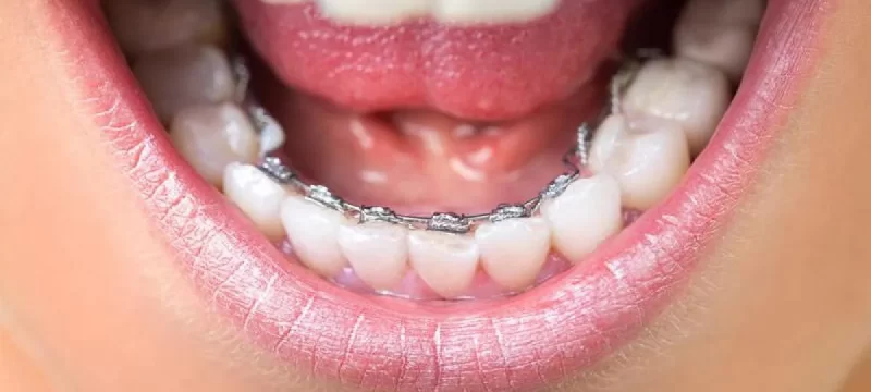 What are invisible braces? - Premium Dental